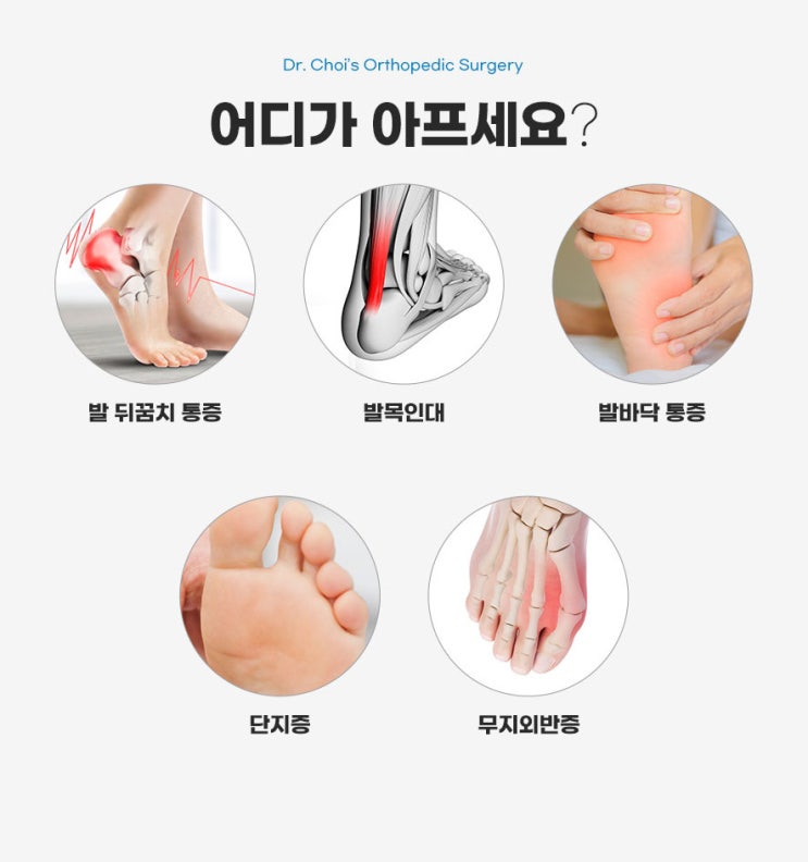 발목 인대 파열 증상 방치하면 보행 장애까지 네이버 블로그