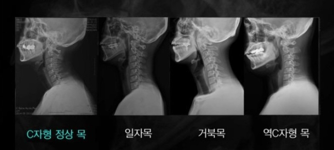역삼동필라테스 리벨르필라테스 한티점 목·어깨가 너무 아파요 일자목 거북목 역커브 네이버 블로그