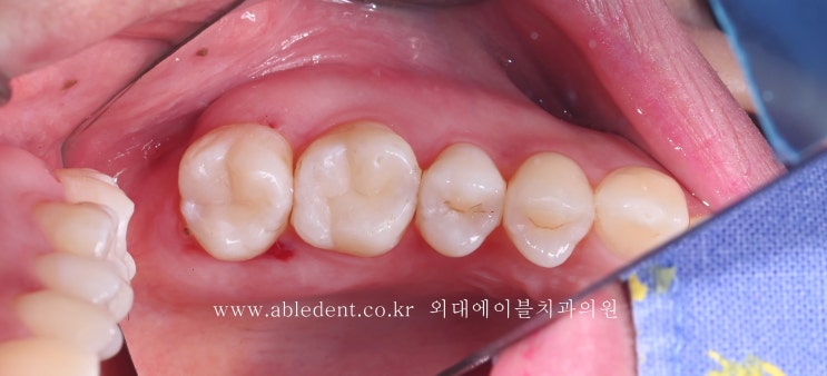 오래된 아말감을 교체해 드린 증례 아쿠아 케어를 이용한 어금니 레진 빌드업 치료 네이버 블로그