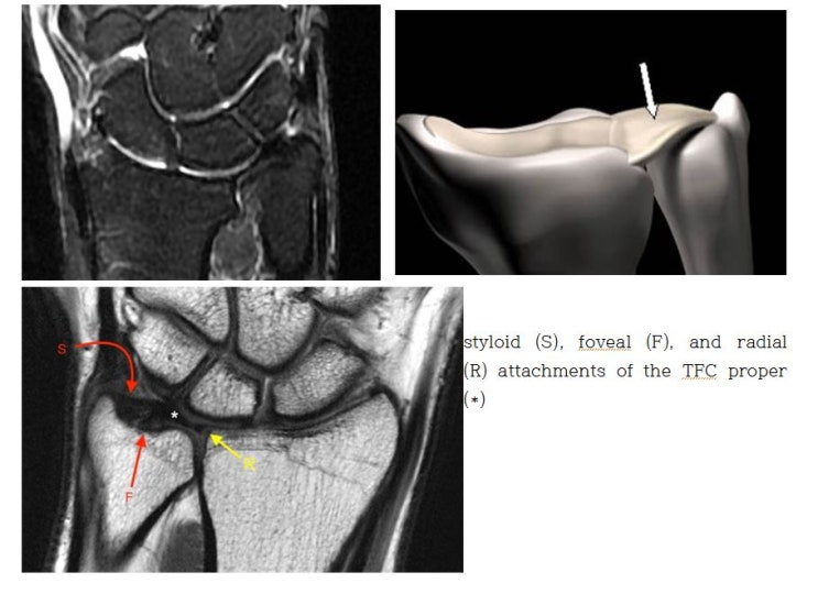 Wrist 손목 MRI 증례: TFCC 삼각 섬유연골 복합체 손상 : 네이버 블로그