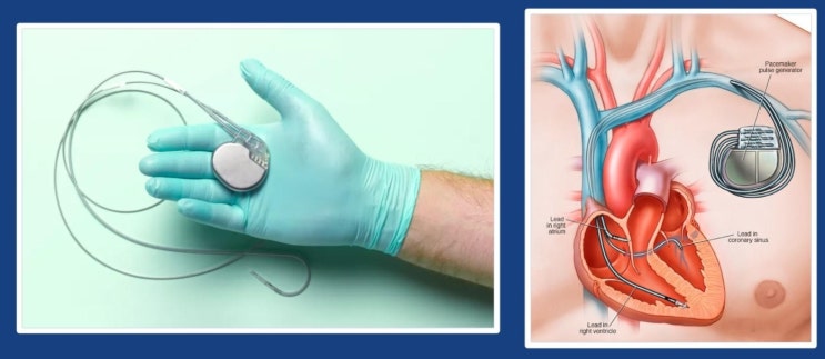 심사노트) Pacemaker(인공심박조율기) : 네이버 블로그