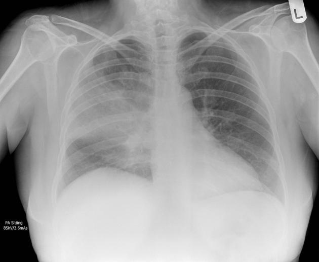 RML(right middle lobe) syndrome : 네이버 블로그