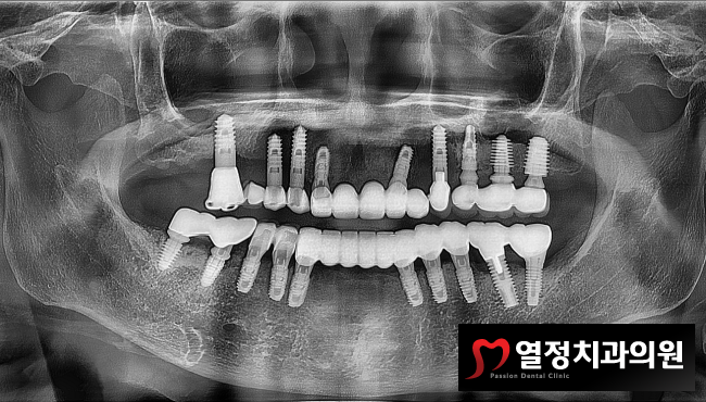 전주 치과 추천 임플란트 잘하는 치과 치아 상실 및 발치 후 임플란트는 열정치과에서 네이버 블로그