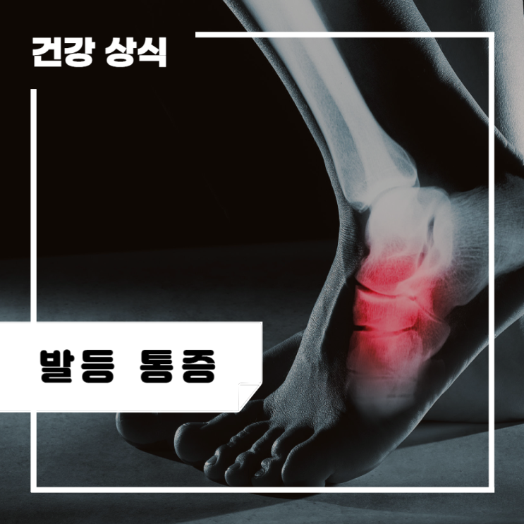 발등이 아픈 이유 5가지와 발등 통증 원인 피로 골절 결절종 중족골 골절 걸을때 네이버 블로그