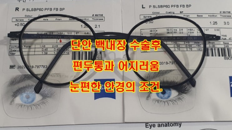 백내장 수술후 나타난 불편함으로 힘들어하고 있습니다 단안 백내장과 눈상태 그리고 적절한 안경추천 네이버 블로그