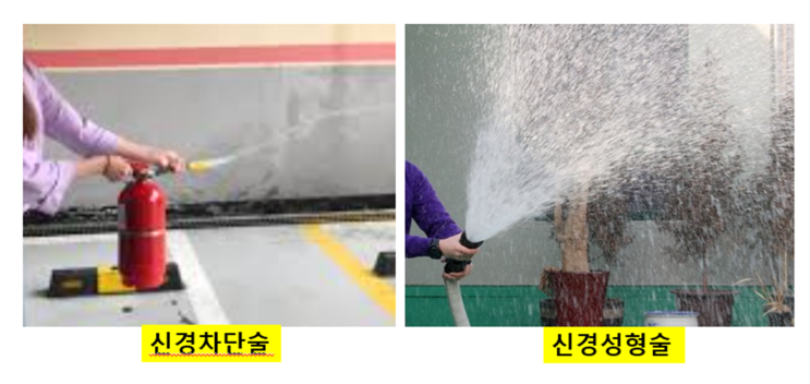 6 허리 디스크 치료 5편 시술적 치료에 대하여 신경성형술 의정부 척추관절 네이버 블로그