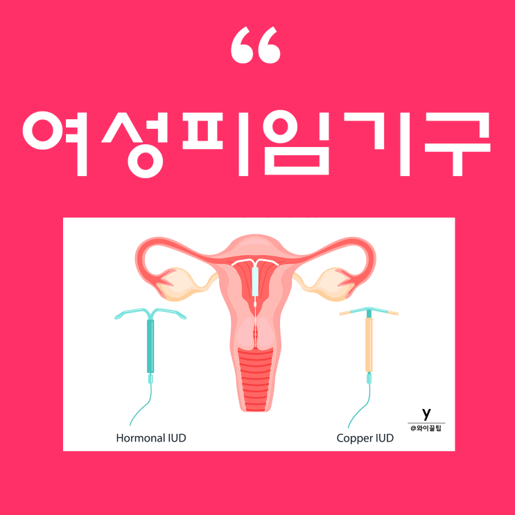 여성 피임 방법 임플라논 미레나 루프 시술 효과 부작용 가격 제거 자궁근종 부정출혈 통증 체중증가 네이버 블로그
