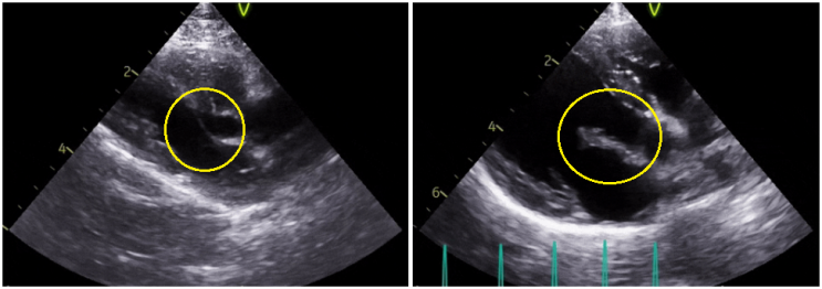 강아지 판막질환, 이첨판 질환 / 점액종성 승모판 질환 / MMVD / 승모판 폐쇄부전증 / MVI / ACVIM stage ...