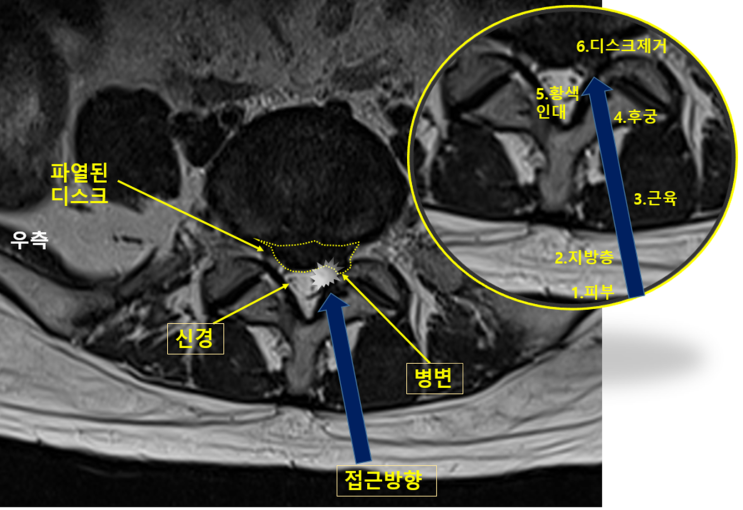 9 허리 디스크 치료 8편 수술적 치료 디스크 수술의 방법 네이버 블로그