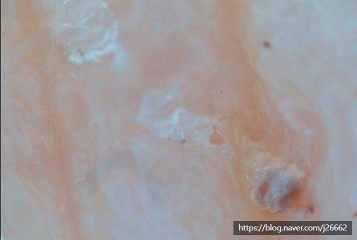 오늘 발견한 옴진드기 굴과 옴 진드기 사진 200배 확대 네이버 블로그