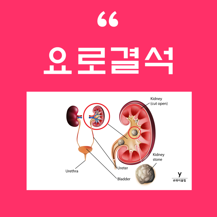 요로결석 신장결석 방광결석 요관결석 원인 증상 왼쪽 오른쪽 옆구리통증 여자 성인 요로감염 제거 치료 예방 콩팥 요석 요도