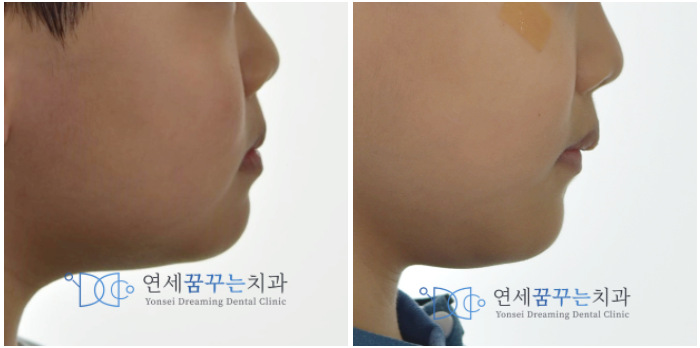 미사어린이치과소아부정교합 교정치료 후 2년 뒤 근황 잘 따라와준 고마운 어린이의 교정 증례 네이버 블로그