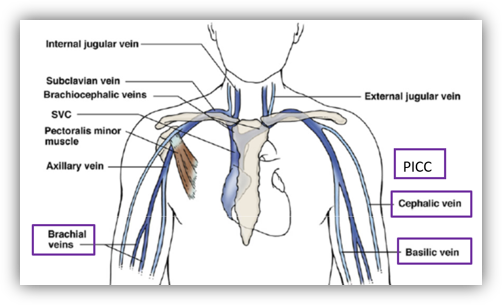 PICC(Peripherally inserted central catheter, 말초 삽입 중심 정맥카테터) : 네이버 블로그
