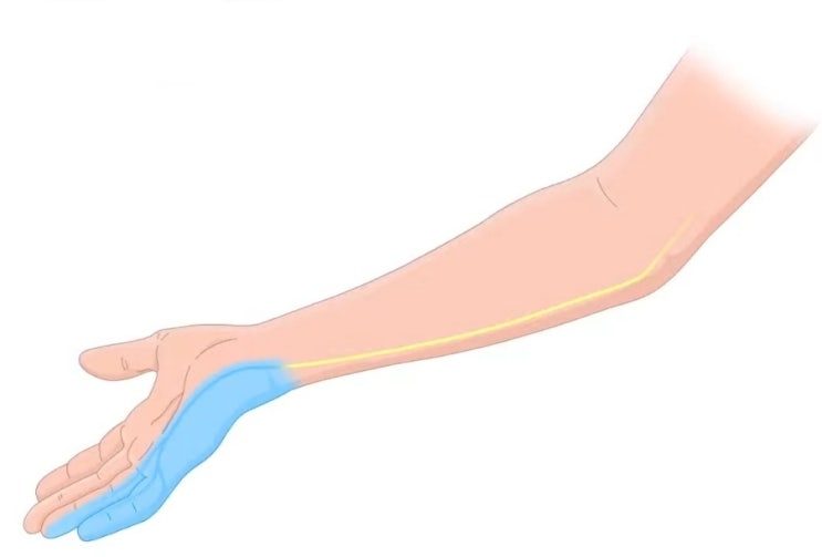 팔꿈치터널 증후군 (Cubital tunnel syndrome) : 수동 팔꿉관절 굽힘 검사(Passive elbow ...