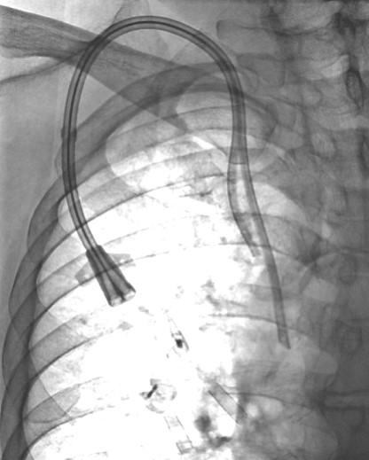 투석 카테터 (Hemo-cath, Perm cath) : 네이버 블로그