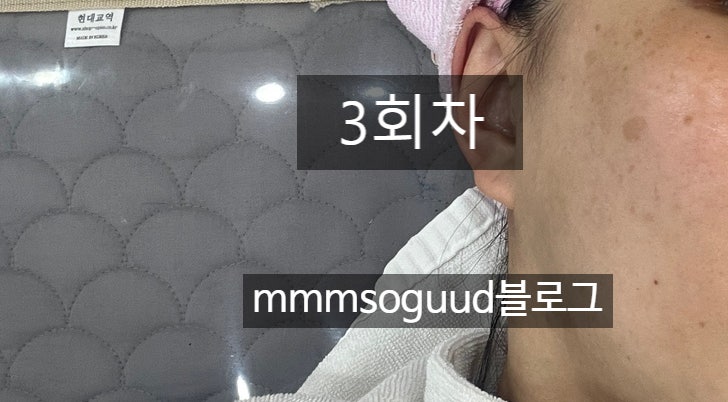내돈내산강남역 피부과 사이노슈어 아꼴레이드 And 피코슈어 잡티 기미 레이저 4회차 후기 네이버 블로그