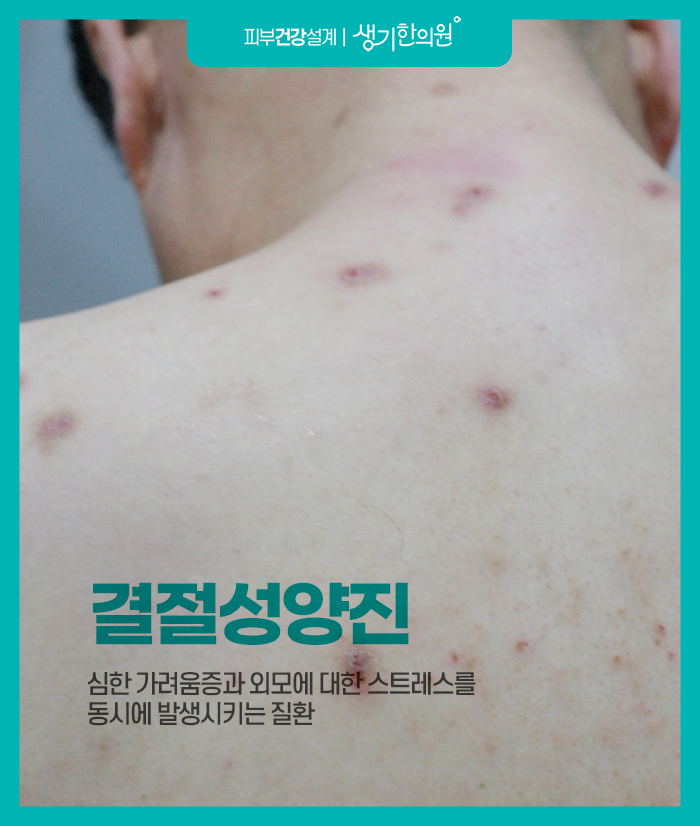 결절성양진 다리부터 전신까지 올라와 가려움으로 힘드신 분들을 한의원 치료방법 네이버 블로그