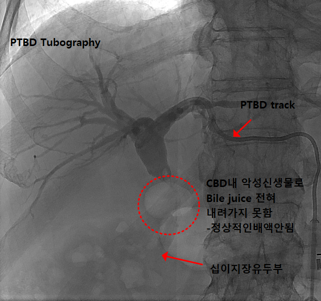 악성신생물로 인한 담도폐쇄시 시행하는 담도스텐트삽입술(CBD Stent 삽입술) : 네이버 블로그