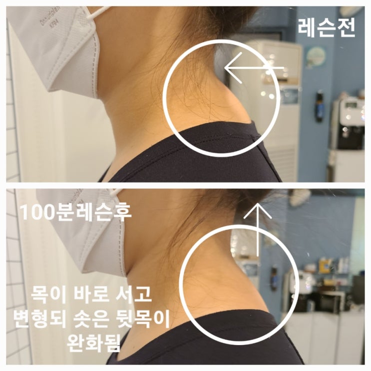 춘천필라테스 체형교정 전문 바른몸만들기 바른필라테스 원데이교정 변화보기 네이버 블로그