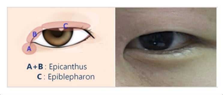 10. Erroneous dichotomous epistemology of Epicanthus and Epiblepharon ...