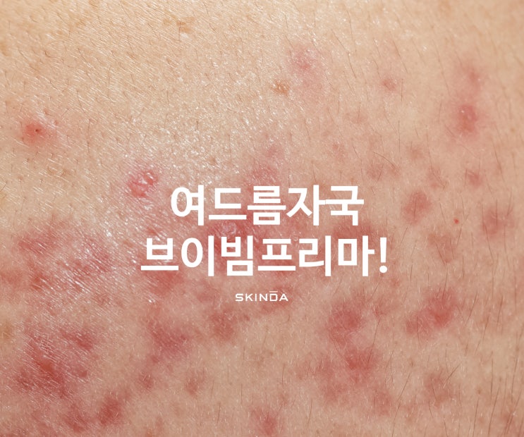 분당 혈관레이저 브이빔프리마의 여드름자국 치료 효과 네이버 블로그