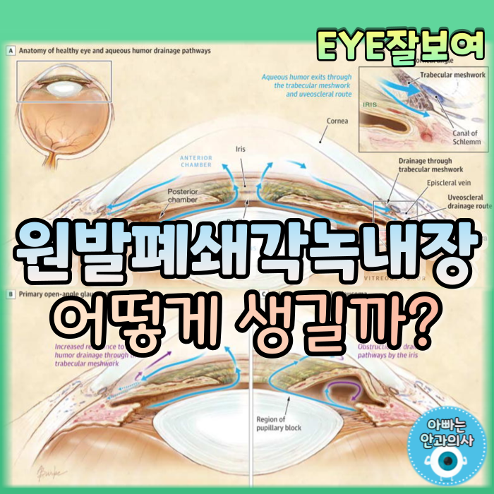 Eye잘보여 원발폐쇄각녹내장 1 분류 발생기전 네이버 블로그
