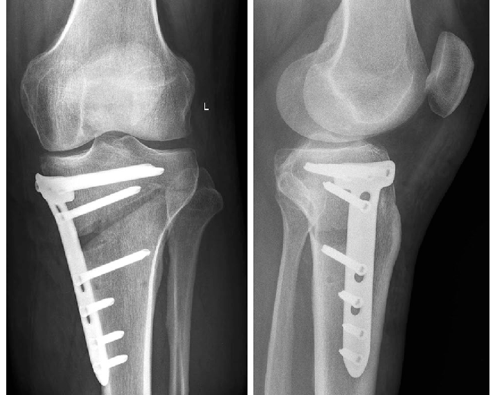 정형외과 :: HTO _ High Tibial Osteotomy _ 근위경골절골술 : 네이버 블로그