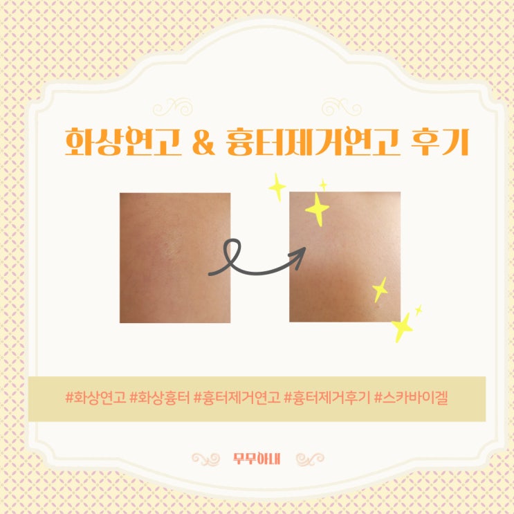 화상연고 흉터제거연고 사용 후기 제왕절개흉터 네이버 블로그