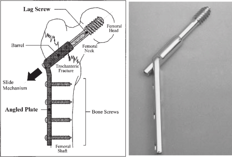 Hip ORIF (AO DHS) : 네이버 블로그