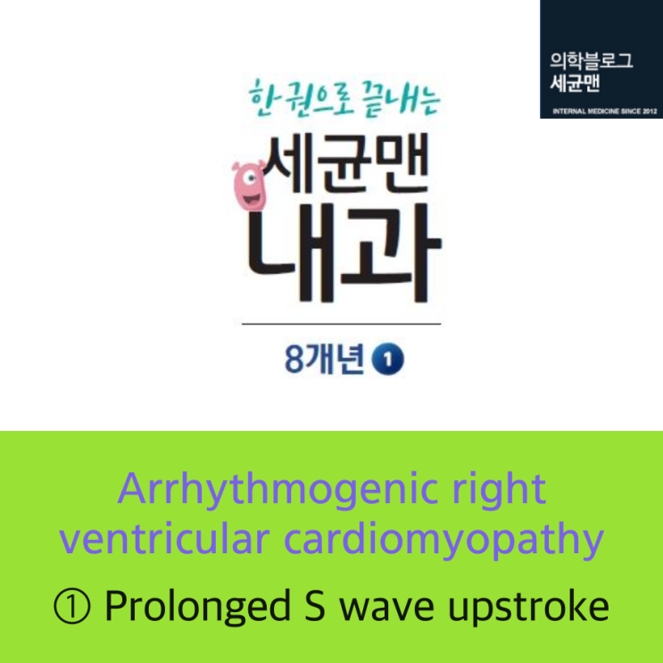 [ECG] Arrhythmogenic right ventricular cardiomyopathy (ARVC) : ① ...