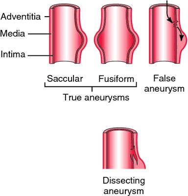 복부대동맥류 : abdominal aortic aneurysms(AAA) : 네이버 블로그