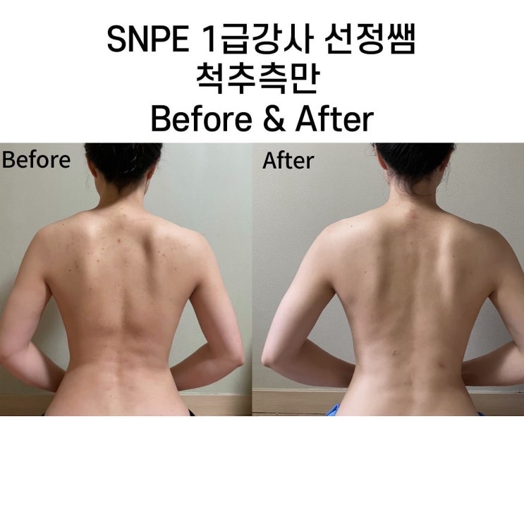 [대구SNPE] 1급 인증강사 선정쌤의 변화 - 측만 : 네이버 블로그