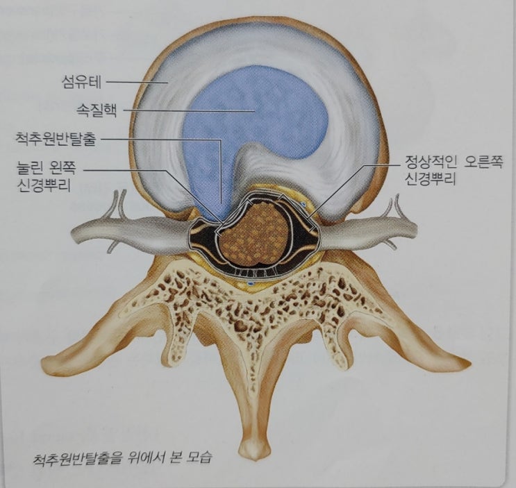 허리디스크추간판탈출증 허리협착증 허리염좌 좌골신경통 허리 말초신경압박 기타자극요법으로~ 네이버 블로그