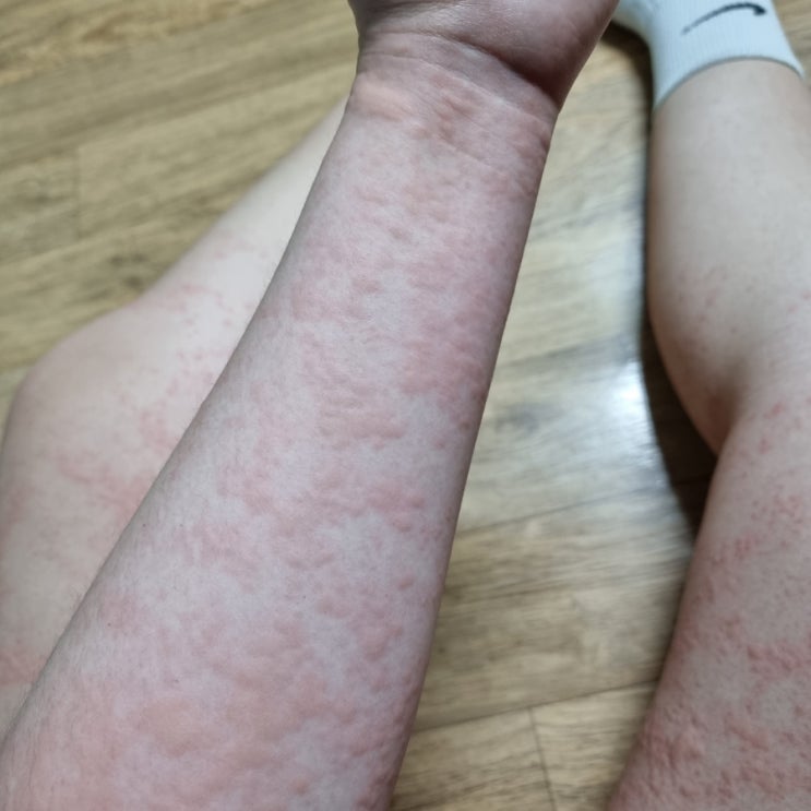 음식물의존성 운동유발성 아나필락시스(FDEIA)보유자의 후기? : 네이버 블로그