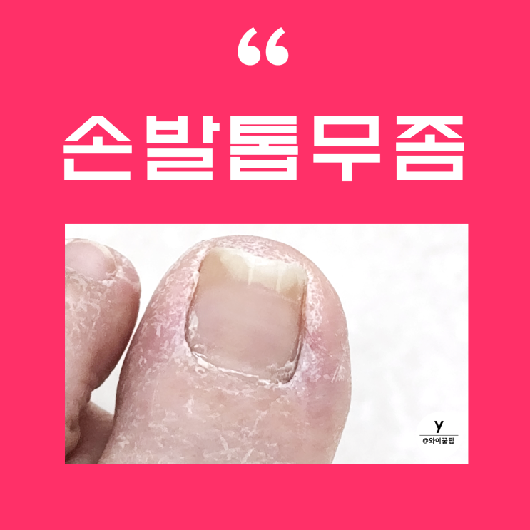 손발톱 무좀 증상 치료 손톱 발톱 무좀약 추천 먹는 바르는 새끼 엄지 여자 레이저 네이버 블로그