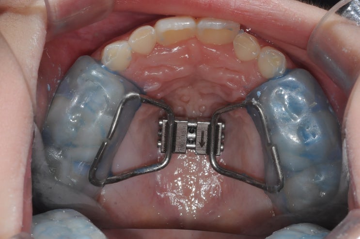 Bonded RPE (본디드 알피이)의 제거 후 주의사항 : 네이버 블로그