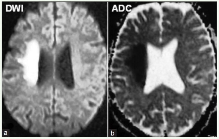 DWI에서 나타나는 T2 shine-through effect 그리고 ADC - brain MRI 영상 이해하기 : 네이버 블로그