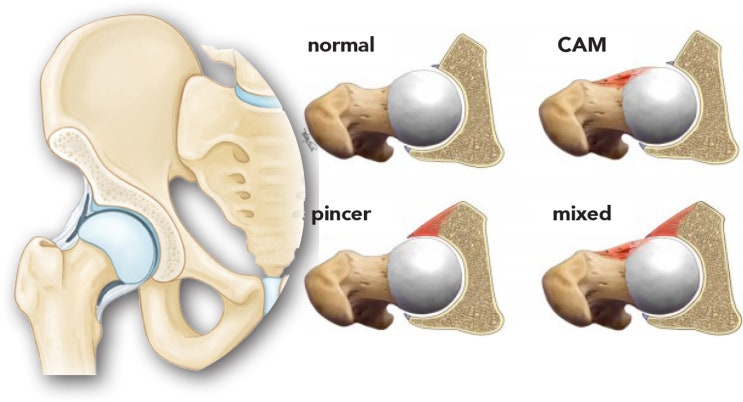 고관절 충돌증후군(Hip impingement syndrome) : 네이버 블로그