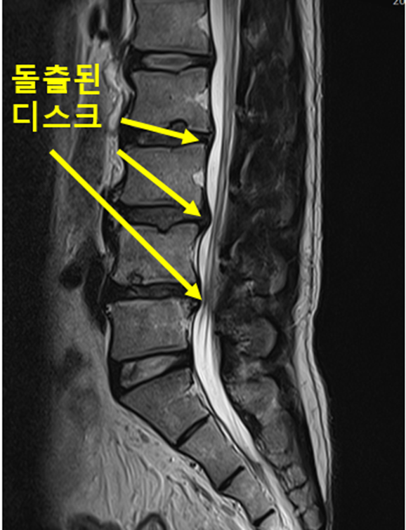 디스크내장증 비수술 요법 치료사례 1 신경성형술 네이버 블로그