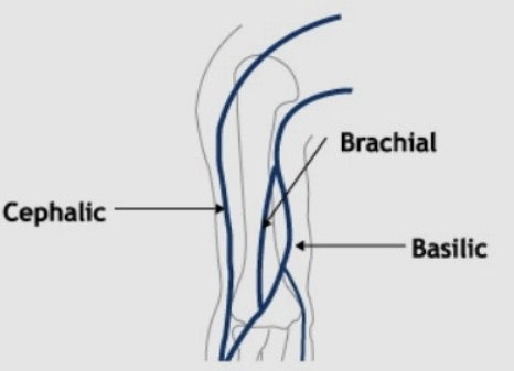 [study] PICC (Peripherally Inserted Central Catheter) 간호 : 네이버 블로그