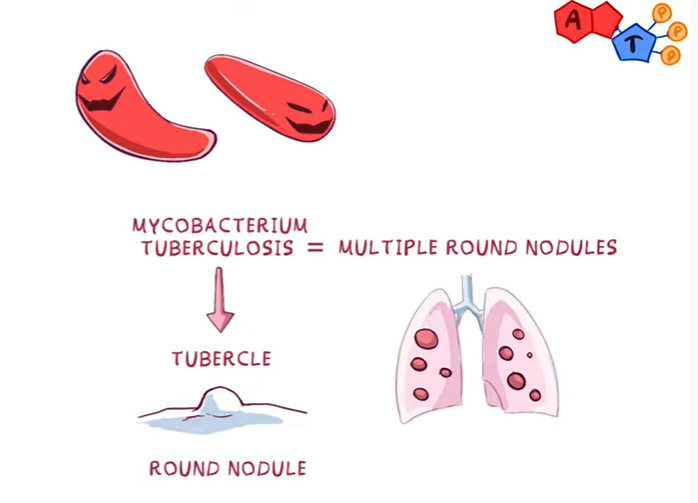 Mycobacterium tuberculosis (TB) : 네이버 블로그