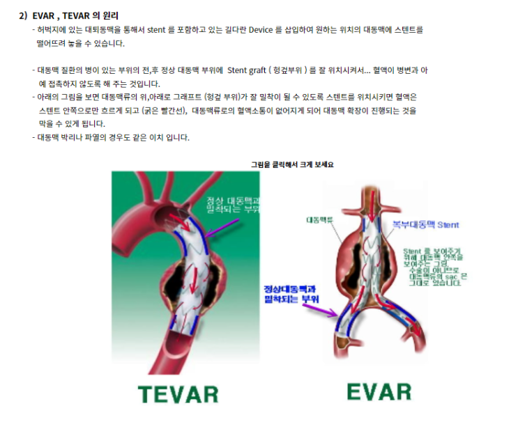 EVAR, TEVAR에 관해서 : 네이버 블로그