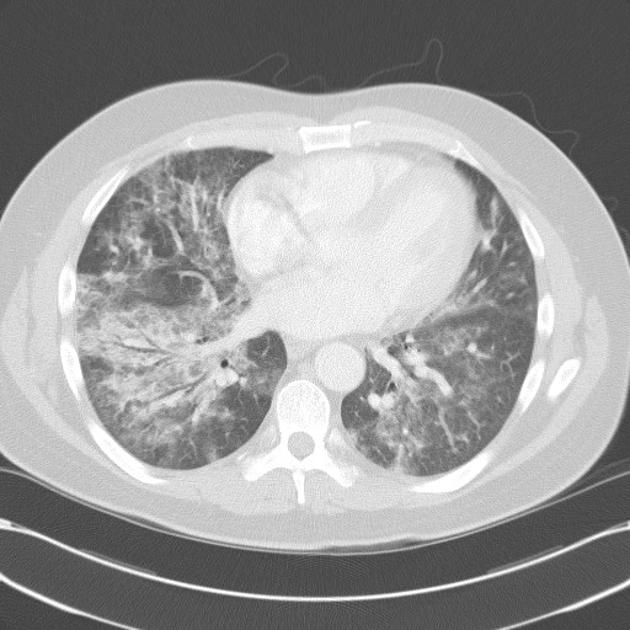 Pneumocystis pneumonia (PJP, PCP, 폐포자충 폐렴) : 네이버 블로그