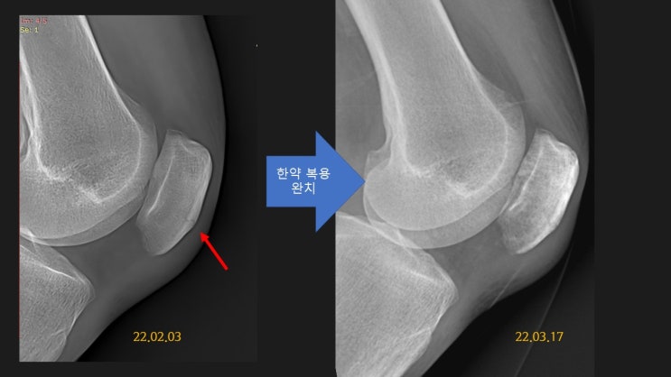 슬개골골절 시 회복 기간이 길어져 고민이라면 네이버 블로그
