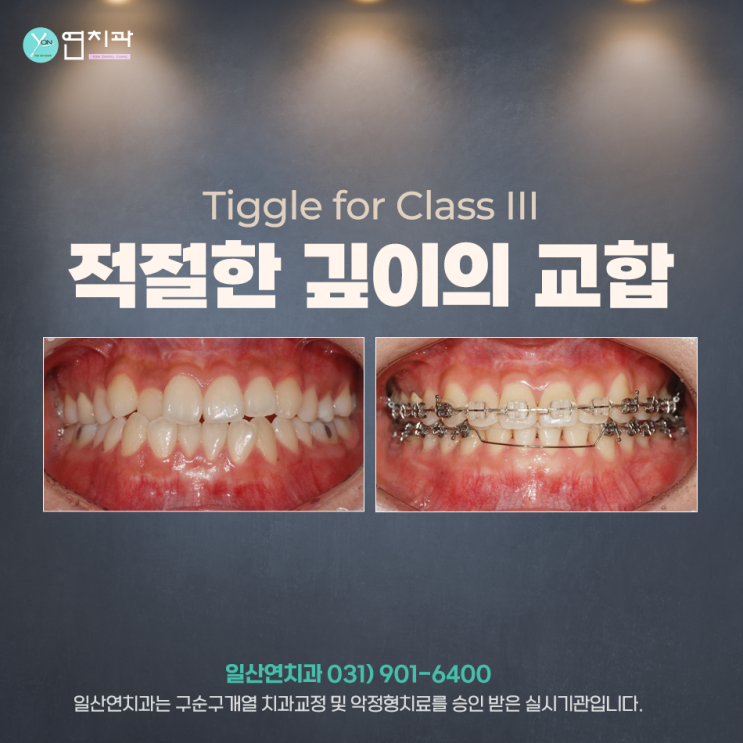 일산치과, 교정잘하는 일산연치과 Tiggle for Class III : 네이버 블로그