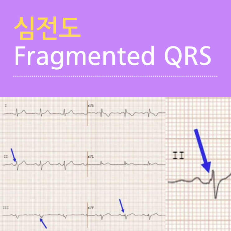 [심전도] Fragmented QRS : 네이버 블로그