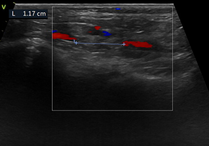 고양이 대동맥혈전색전증 / Feline ATE / Saddle thrombus / 비대성 심근병증 / HCM / HOCM ...