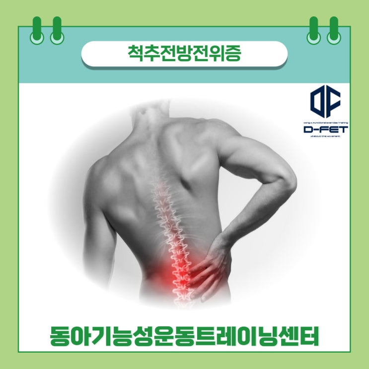 부산재활동아대학교 척추뼈가 앞으로 밀렸다고요 척추전방전위증허리통증다리저림허리재활 네이버 블로그