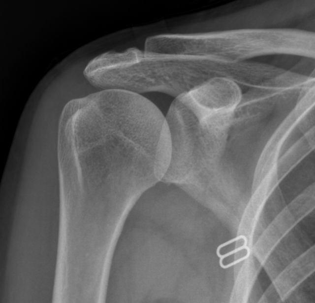 [어깨] Humeral Avulsion Glenohumeral Ligament (HAGL) & IGHL complex 손상의 ...