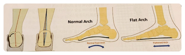 기능적 편평발(functional flat foot) : 네이버 블로그